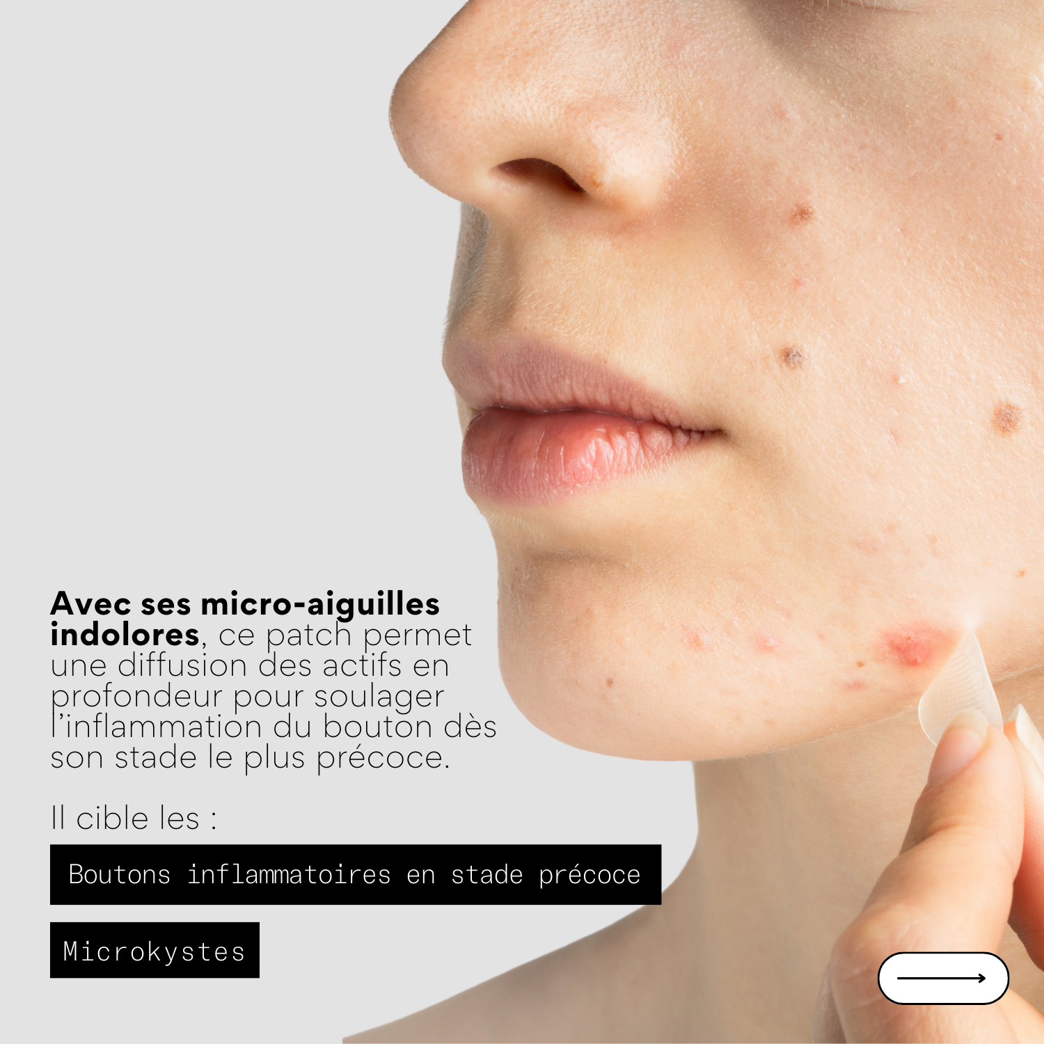 Patchs boutons micro-aiguilles (Microneedling) - Skin & Out