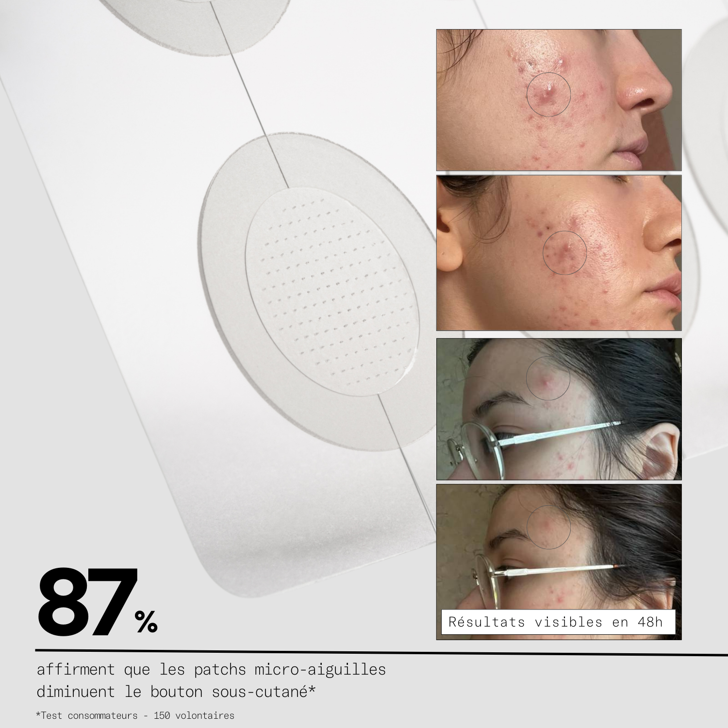 Patchs boutons micro-aiguilles (Microneedling) - Skin & Out