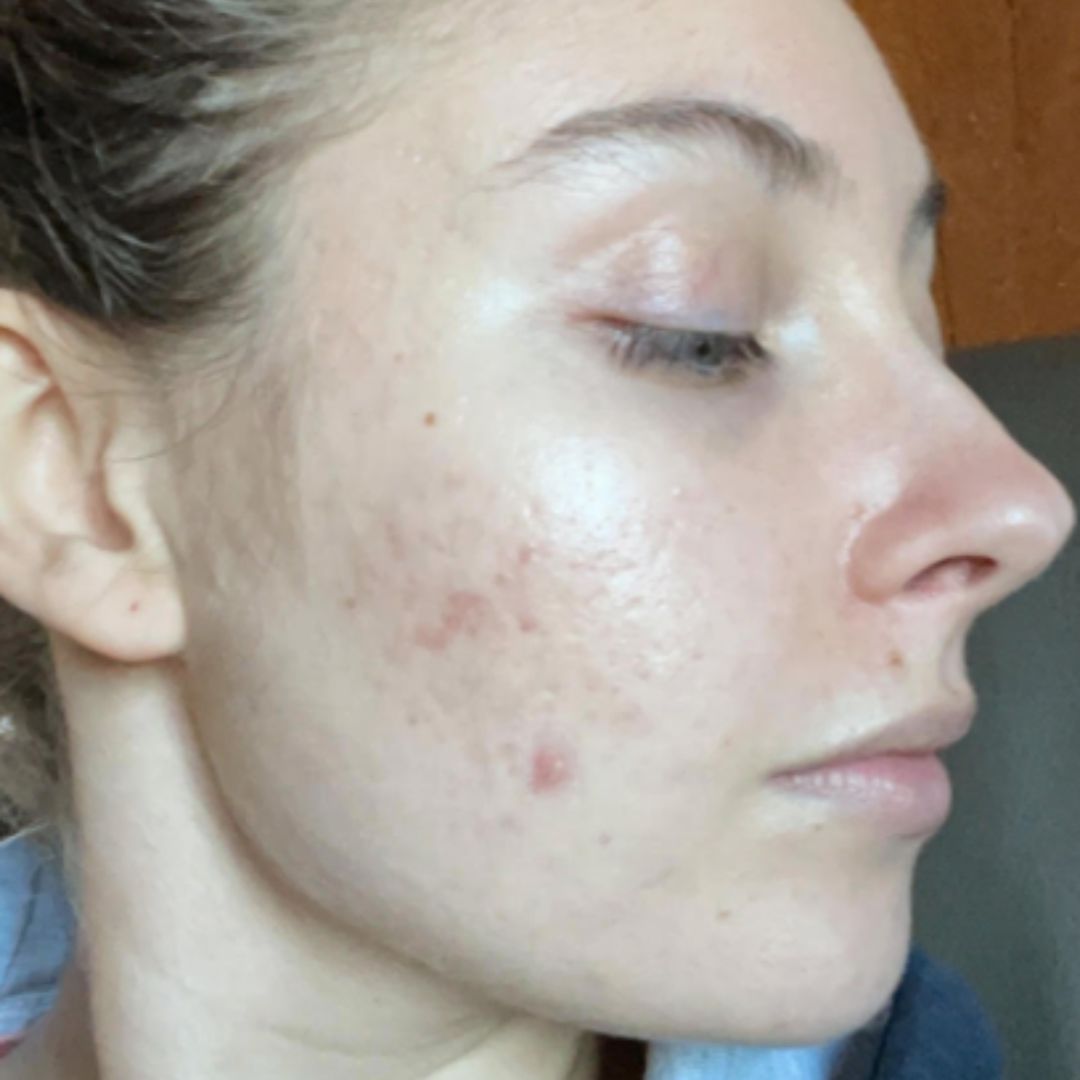 Soin Anti-Tache Acné - 100/100 sur Yuka – Skin & Out