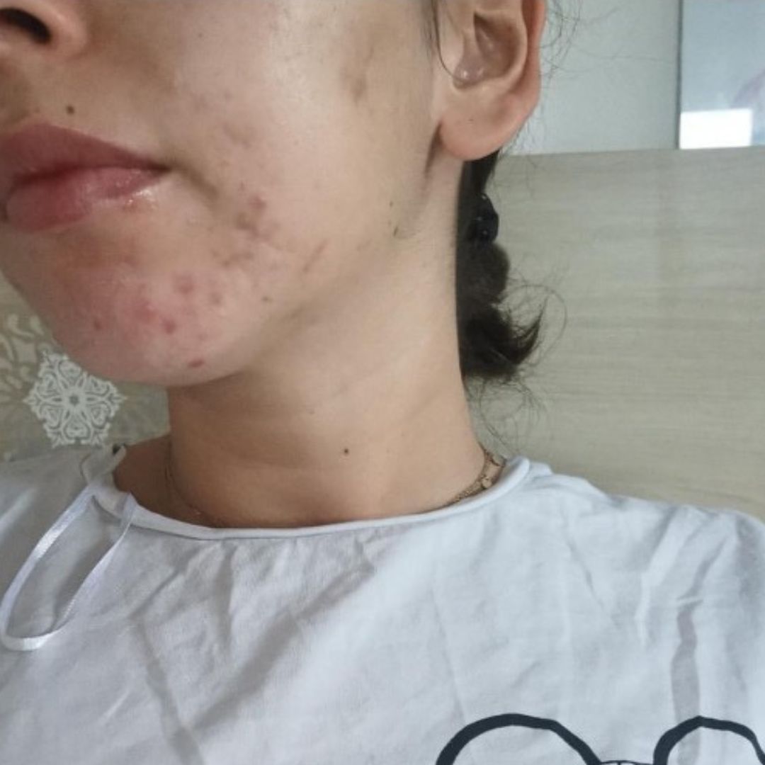 Soin Anti-Tache Acné - 100/100 sur Yuka – Skin & Out