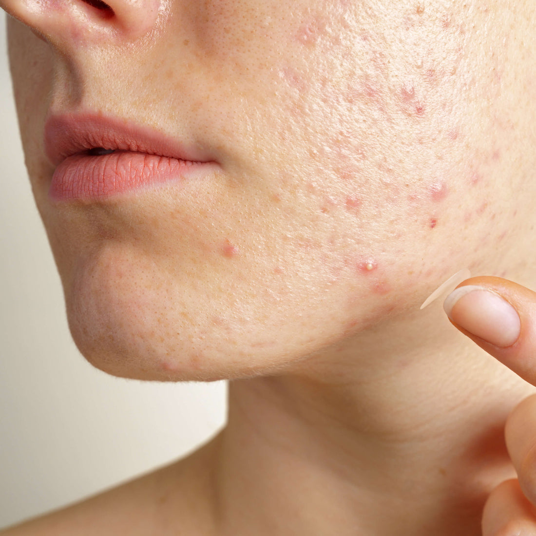 Règles et Acné - Solution Naturelle & Efficace – Skin & Out