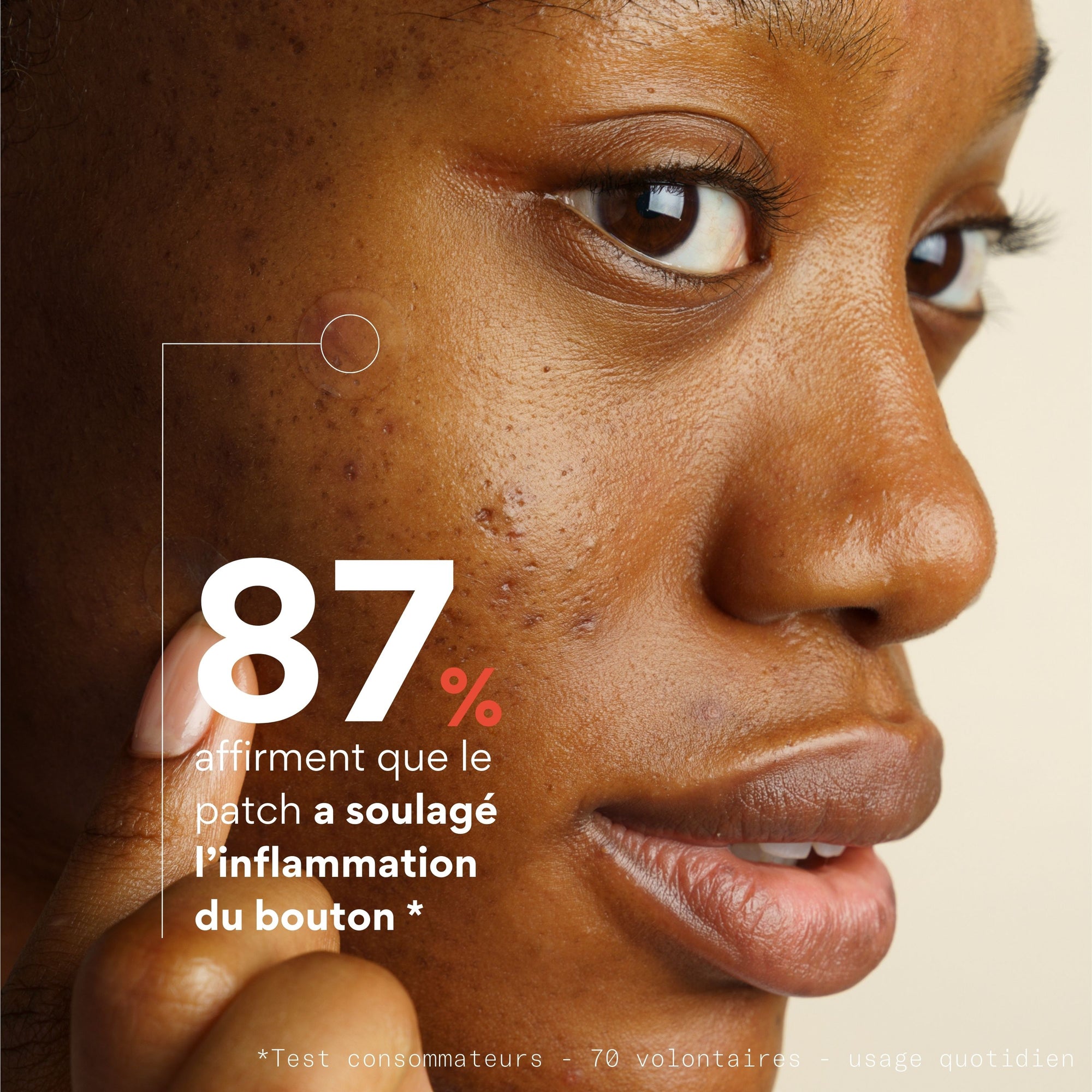 Patchs Boutons Acné - 96/100 sur Yuka – Skin & Out