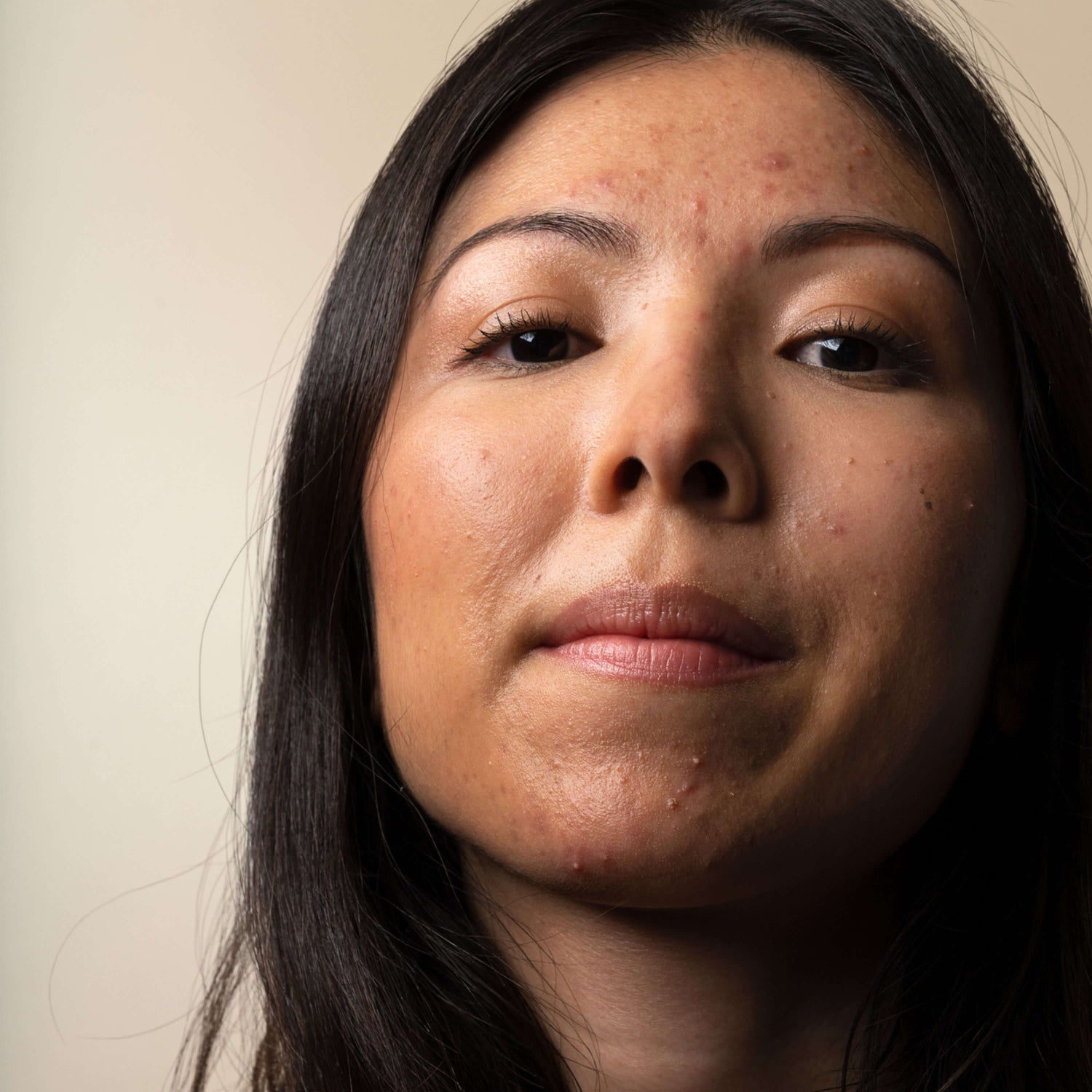 Boutons Blancs et Inflammatoires - Nos Solutions – Skin & Out