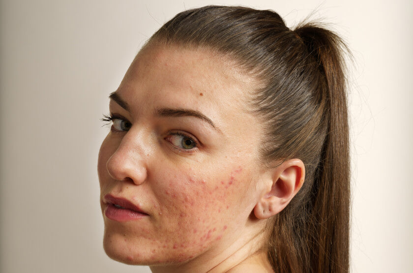 Les taches d’acné : Comment en venir à bout ? – Skin & Out