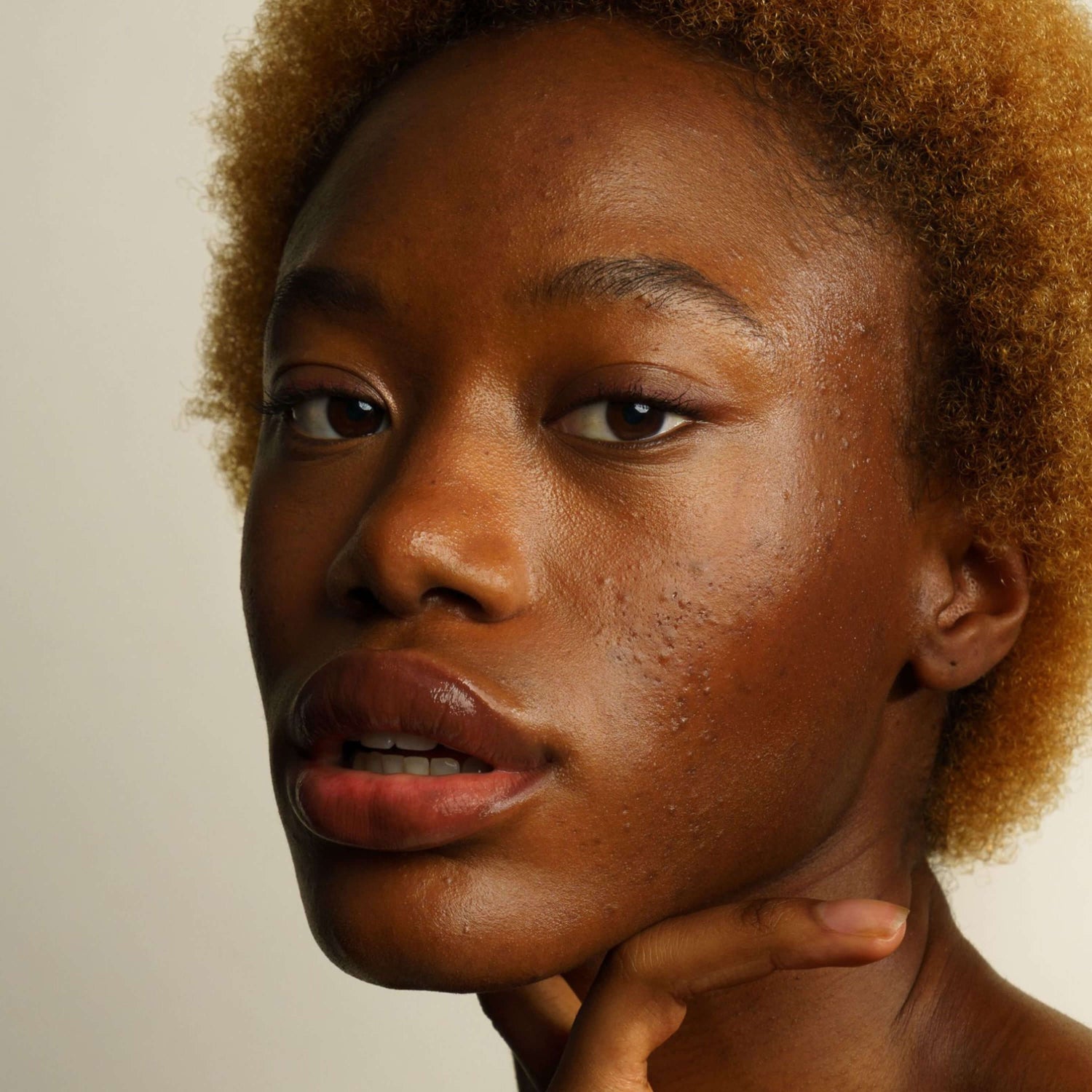 Microkystes et Acné - Nos Solutions – Skin & Out