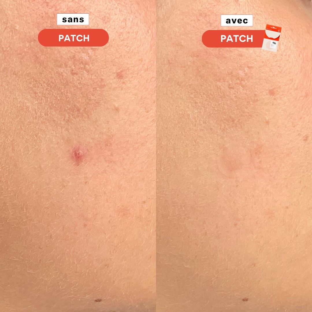 Patchs Boutons Acné - 96/100 sur Yuka – Skin & Out