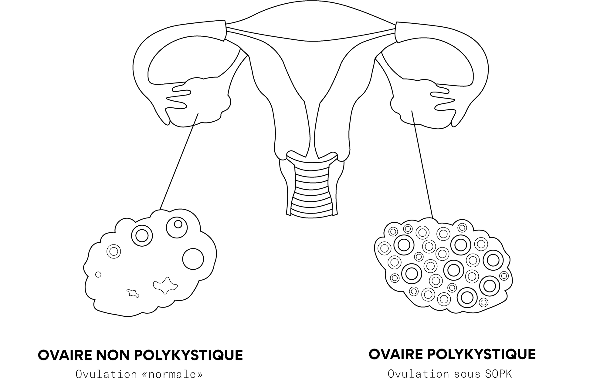 SOPK et Acné - Nos Solutions – Skin & Out