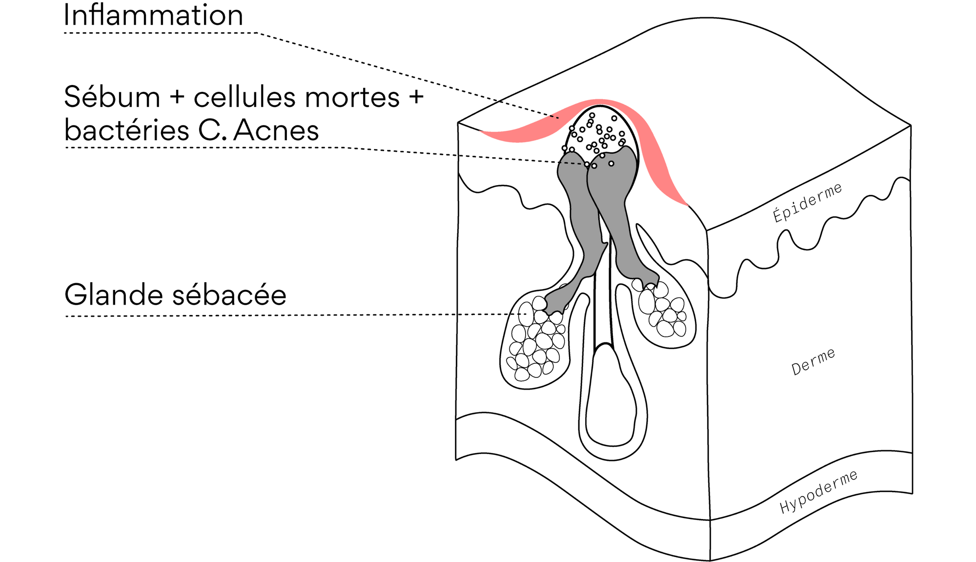 Boutons Blancs et Inflammatoires - Nos Solutions – Skin & Out