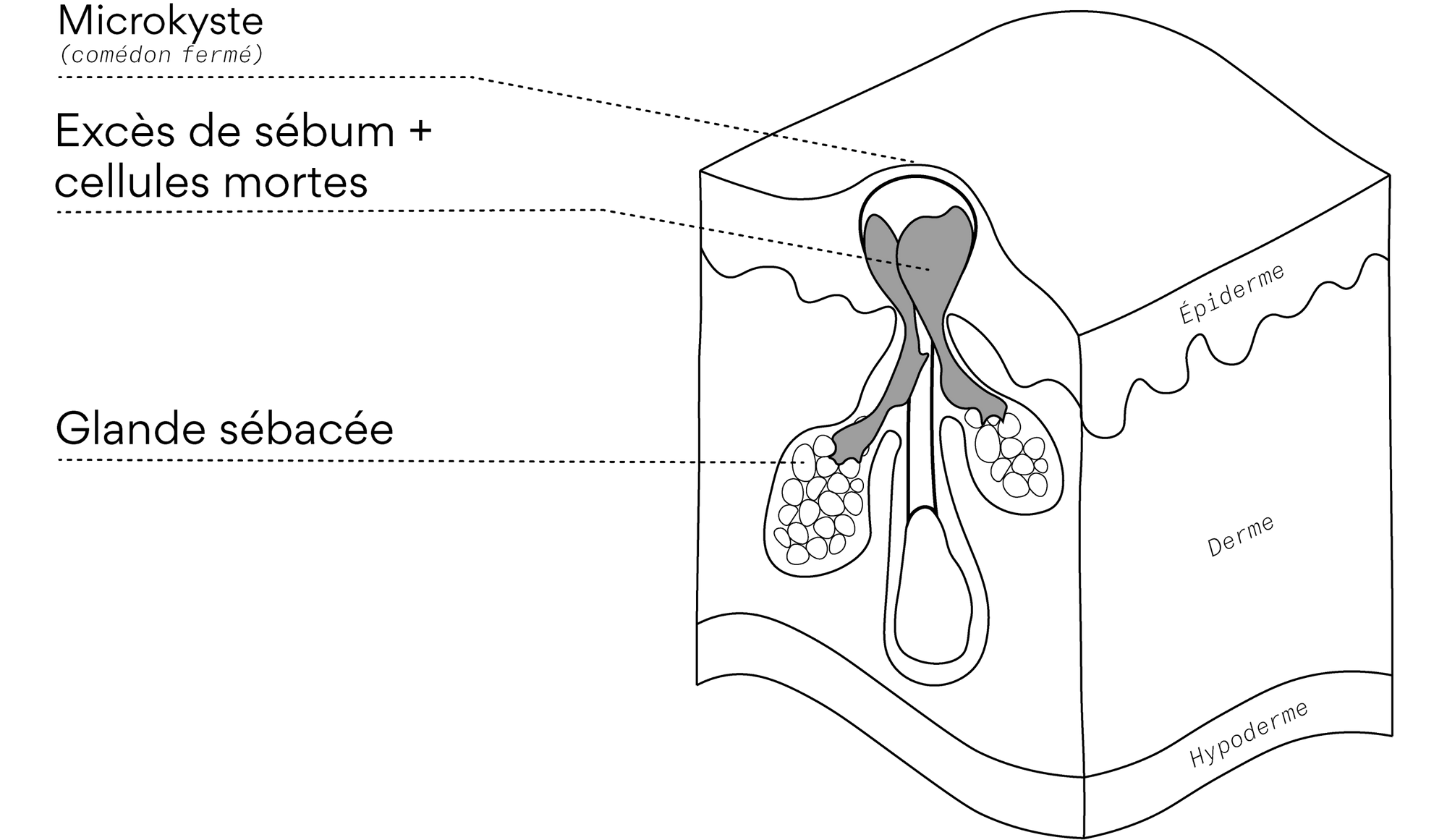 Microkystes et Acné - Nos Solutions – Skin & Out